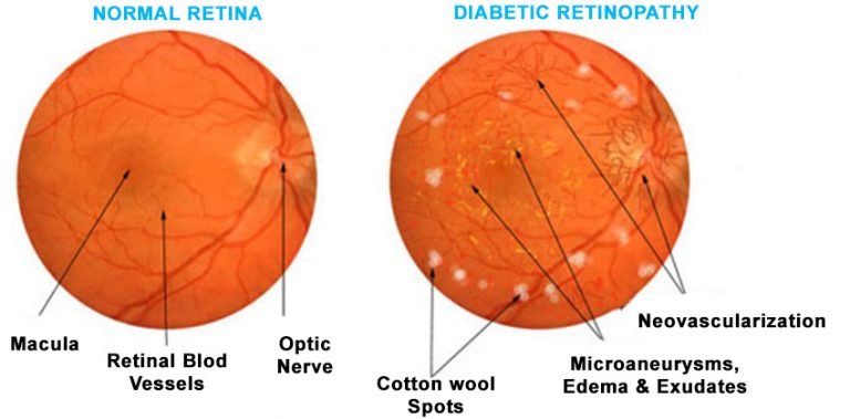 Diabetic Retinopathy- Overview and reason why you need fundoscopic ...
