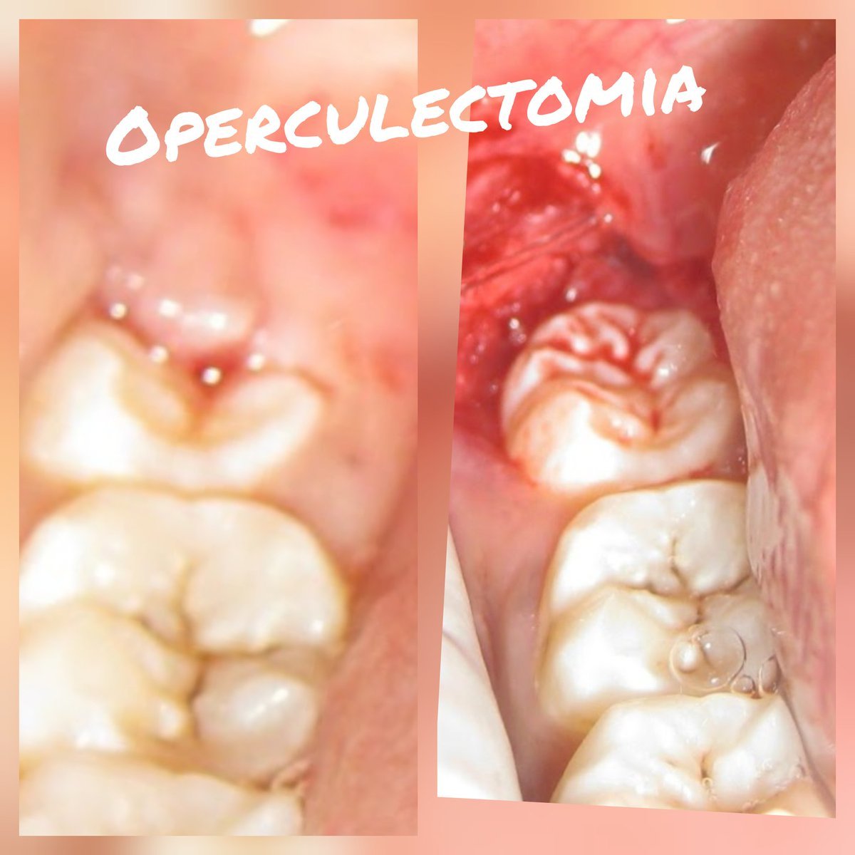 Urgencia en Cuarentena #2 - Operculectomía - Quarantine Emergency #2 ...